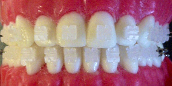 Ceramic Brackets- Full Sets – Cx Orthodontic Supply